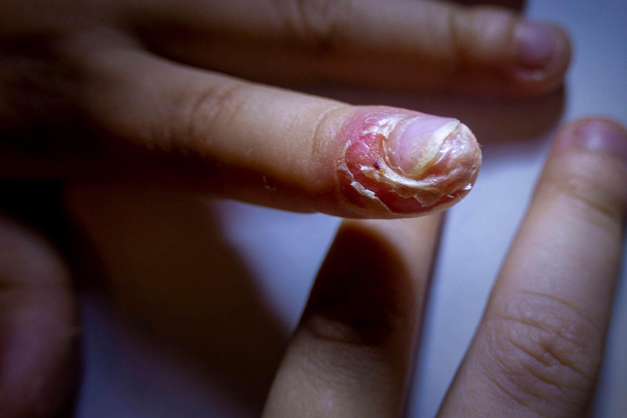 Hair and Nail Disorders | Total Dermatology